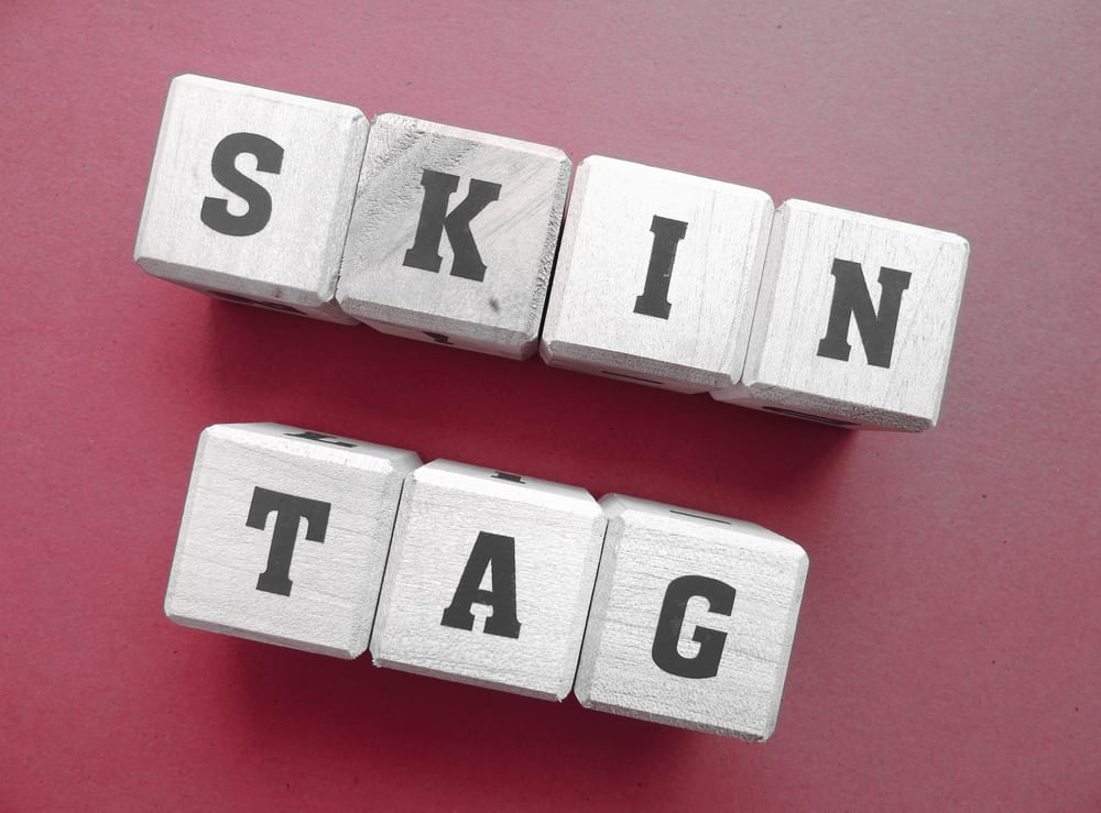 Skin Tags (အသားပို) - Hellosayarwon ....................................